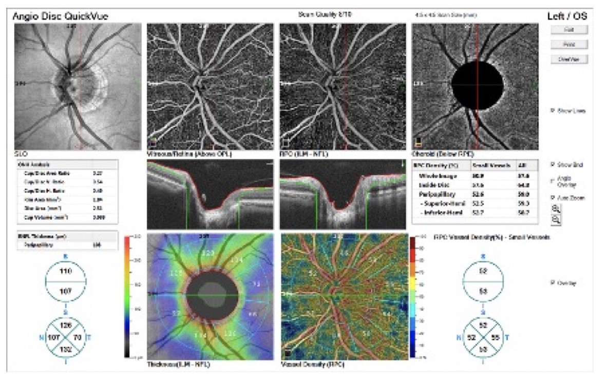 TQ Course | OCT and OCT Angiography in Glaucoma Management (Ponte Vedra ...